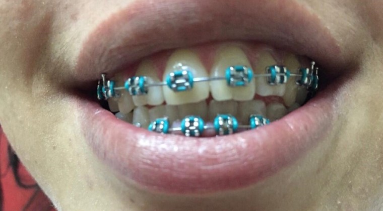 Diario HOY | Salud ofrece provisión y colocación de frenillos gratuitos ...